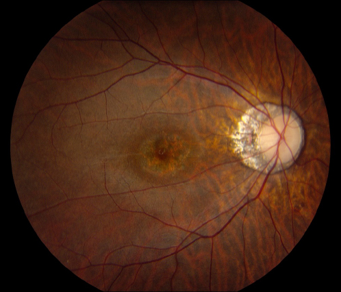 Posterior Segment Differential Diagnoses | 2.3 | Westmead Eye Manual