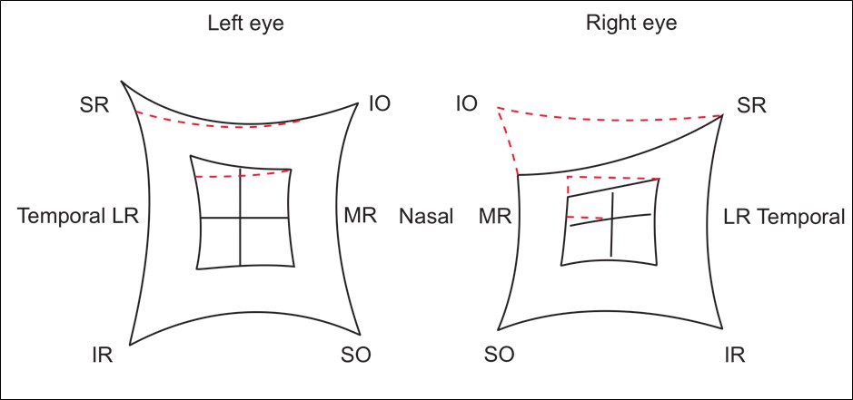 Brown Syndrome | 6.8 | Westmead Eye Manual