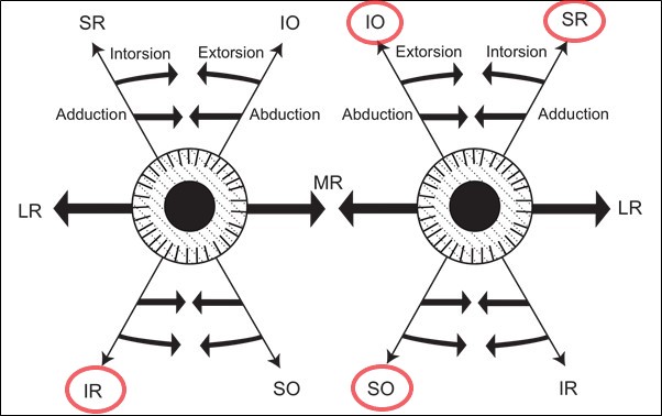 Cranial Nerve IV (Trochlear) Palsy | 7.2 | Westmead Eye Manual