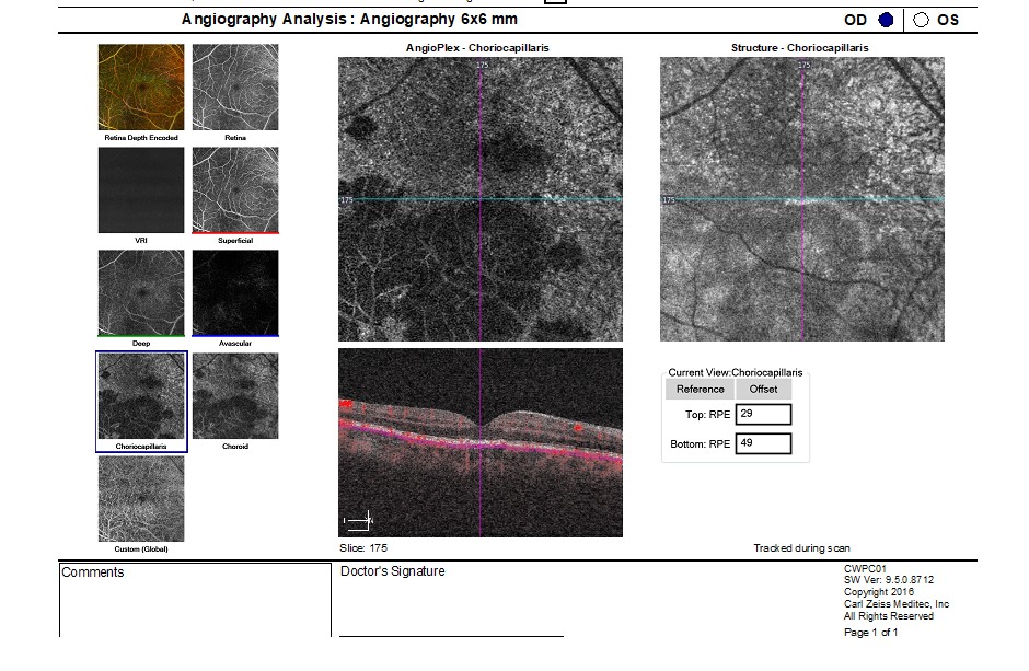 Optical Coherence Tomography Angiography (OCT-A) | 9.4 | Westmead Eye ...